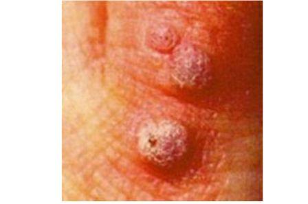 Warts, Romford, Essex & London, Janice's Electrolysis Clinic (formerly ...